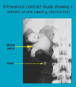 Contrast radiograph of ureteric stone with obstruction – Primary Care ...