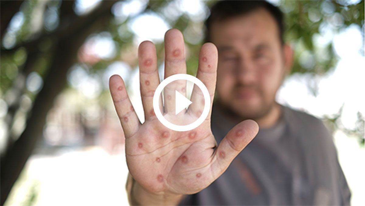 Mpox: clinical presentation, diagnosis and treatment – GPnotebook