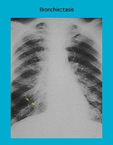 Radiograph showing bronchiectasis – GPnotebook