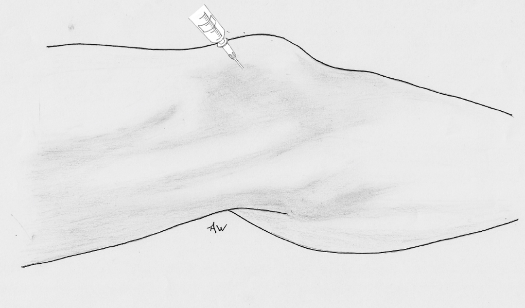 Lateral approach - aspiration or injection of the knee joint – GPnotebook