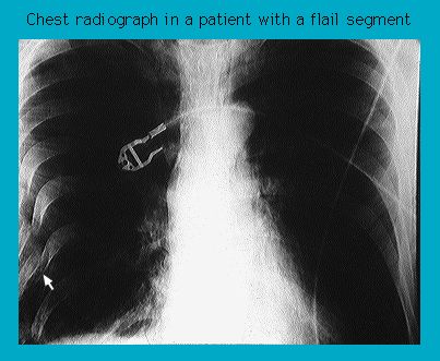 Radiografía torácica de tórax en flecha – GPnotebook