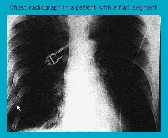 Chest radiograph of a flail chest – Primary Care Notebook