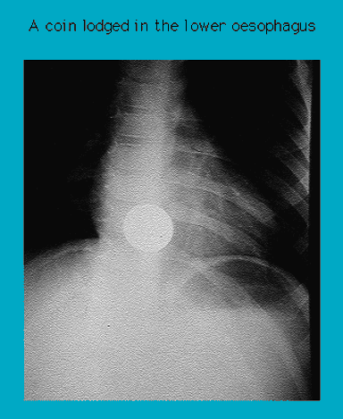 Radiograph of coin in the lower oesophagus – Primary Care Notebook