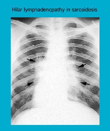 Radiografía que muestra linfadenopatía hiliar en sarcoidosis – GPnotebook