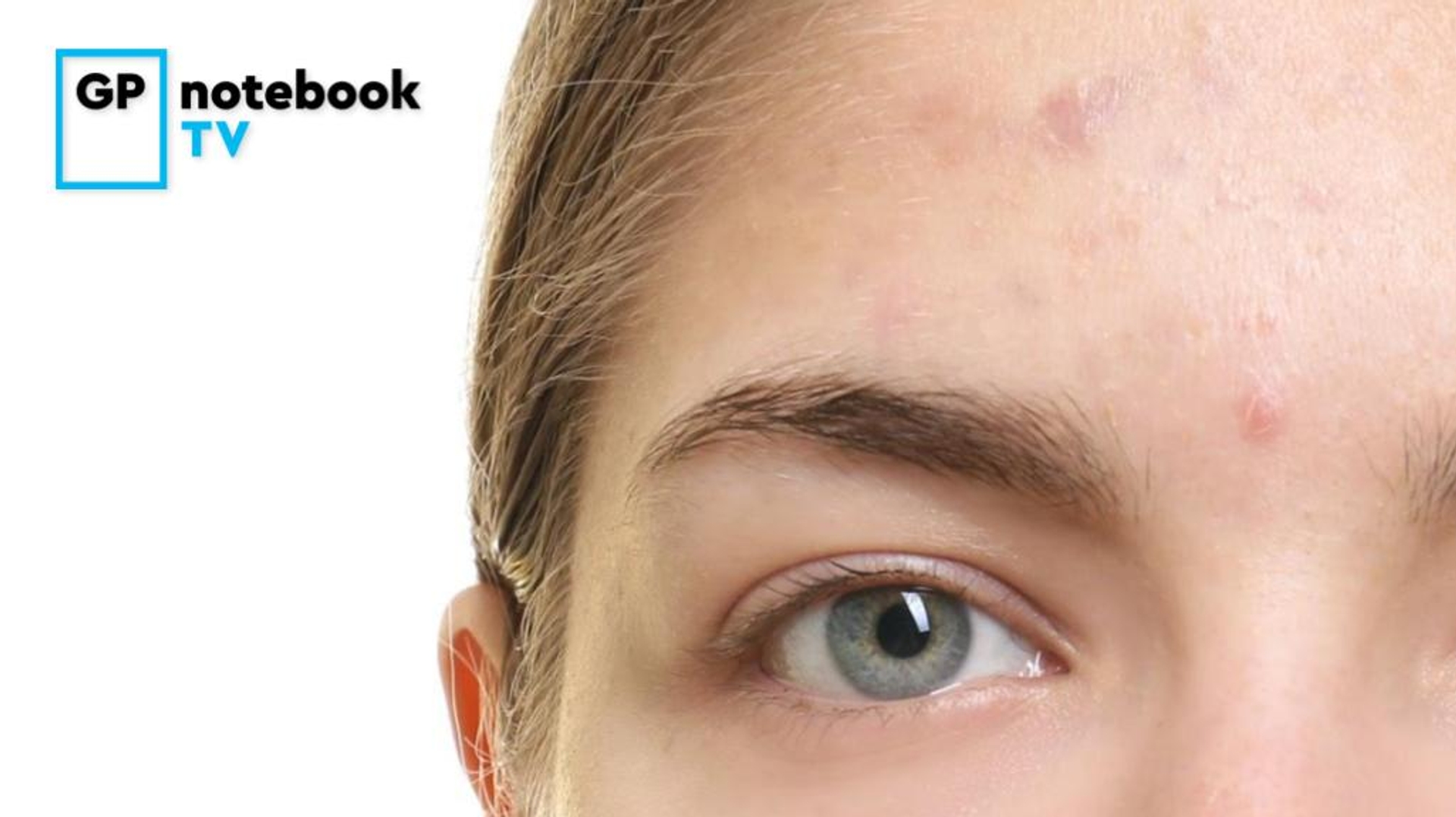 Acne vulgaris: a case-based update