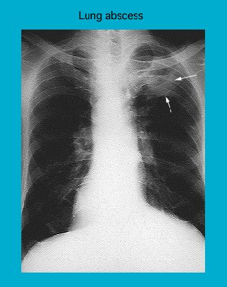 Radiographie d'un abcès pulmonaire – GPnotebook