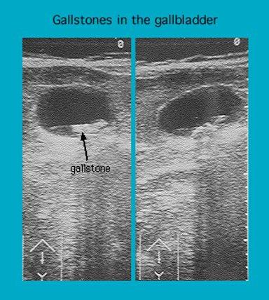 Ultrasound showing gallstones in the gallbladder – Primary Care Notebook