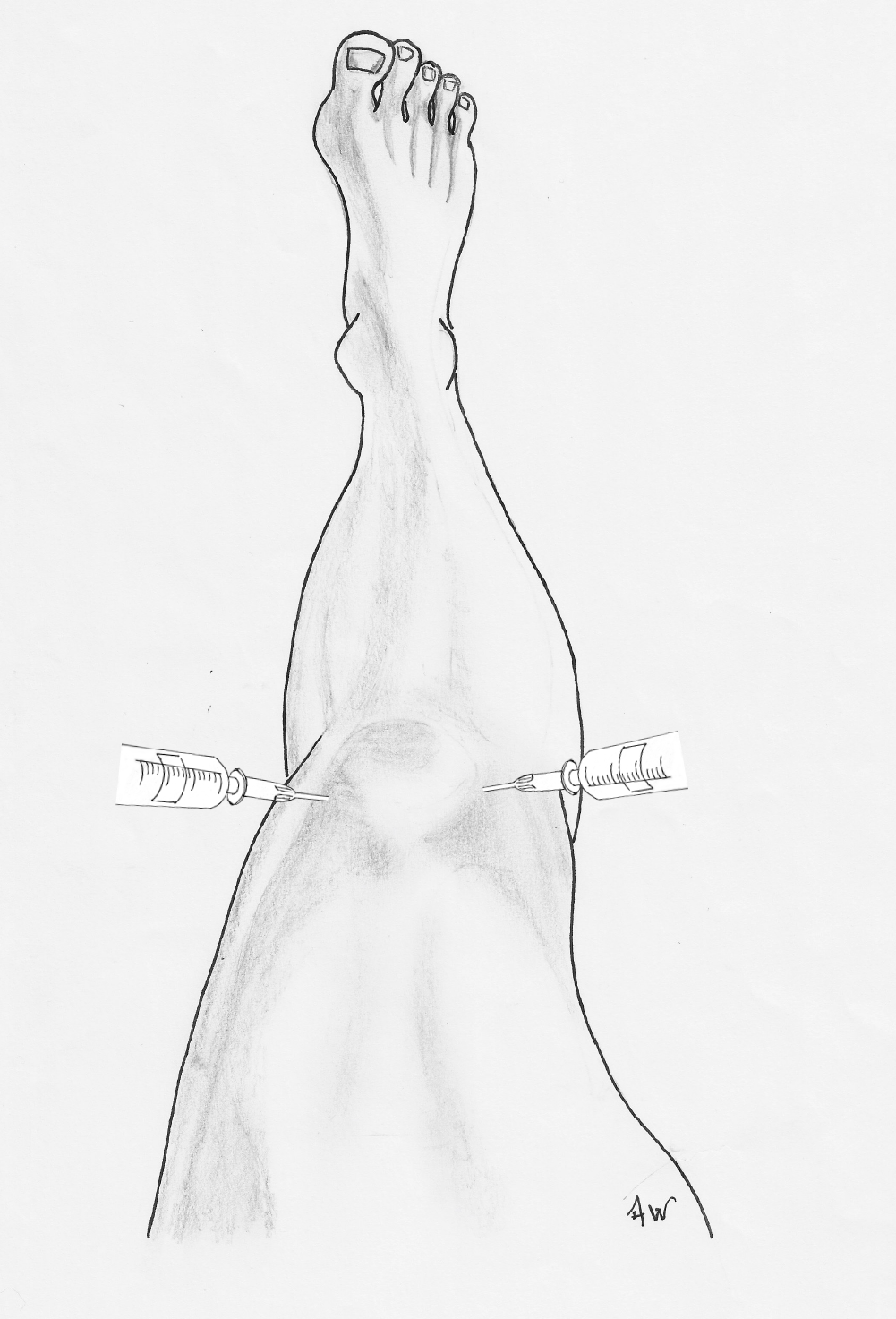 Aspiration or injection of the knee joint – Primary Care Notebook