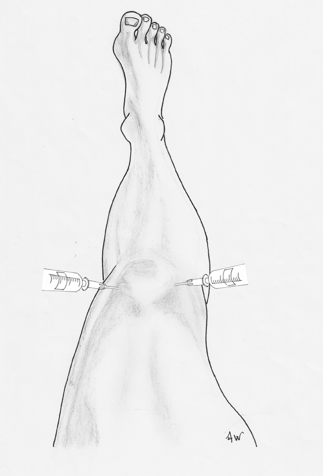Aspiration or injection of the knee joint – GPnotebook - GPNotebook