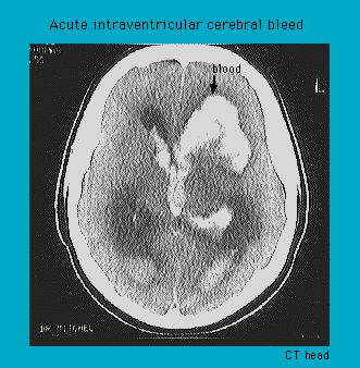 CT scan showing intraventricular haemorrhage – Primary Care Notebook