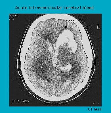 CT scan showing intraventricular haemorrhage – Primary Care Notebook
