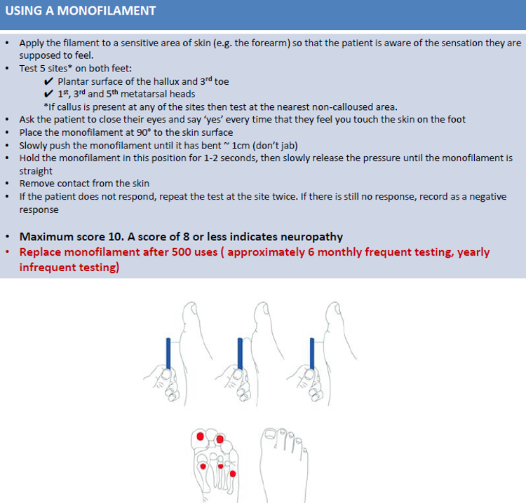 Monofilament testing in diabetic foot – Primary Care Notebook