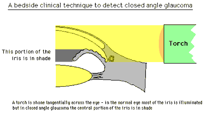 Glaucoma de ángulo cerrado (detección clínica) – GPnotebook