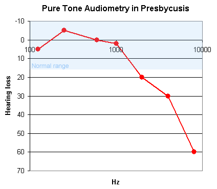Audiogram in presbyacusis – GPnotebook