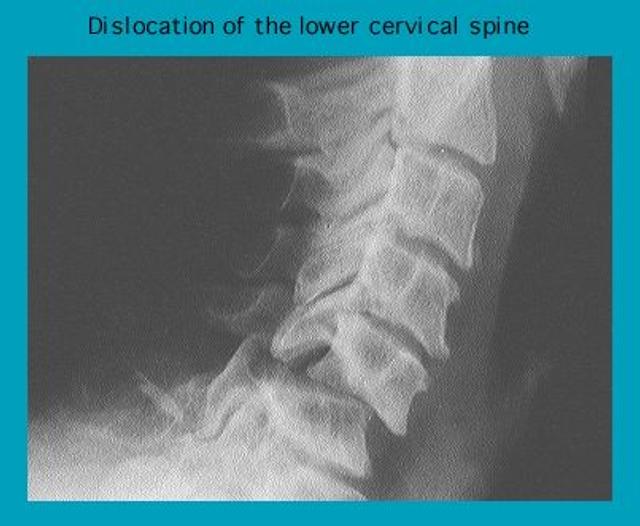 Radiograph of dislocation of the lower cervical spine – GPnotebook