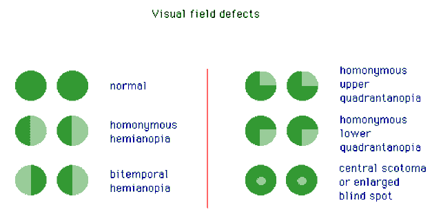 Diagram of visual field defects – GPnotebook
