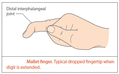Mallet finger – GPnotebook
