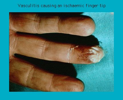 Photograph of an ischaemic finger – GPnotebook - GPNotebook