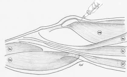 Medial approach - aspiration or injection of the knee joint – GPnotebook