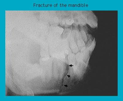 Radiografia de uma mandíbula fracturada – GPnotebook - GPNotebook