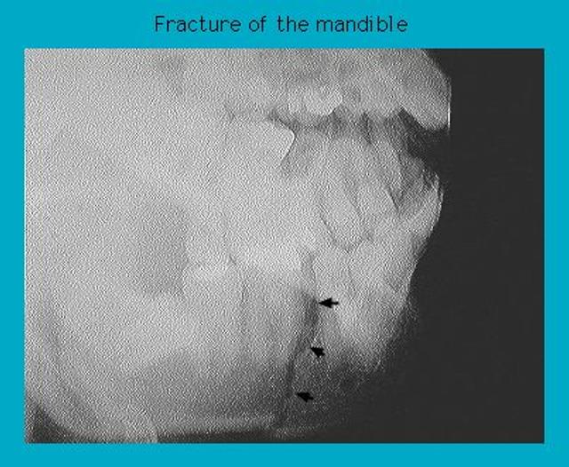 Radiografía de una fractura de mandíbula – GPnotebook