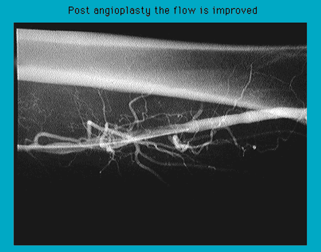 Angiogram of popliteal artery post-angioplasty – Primary Care Notebook
