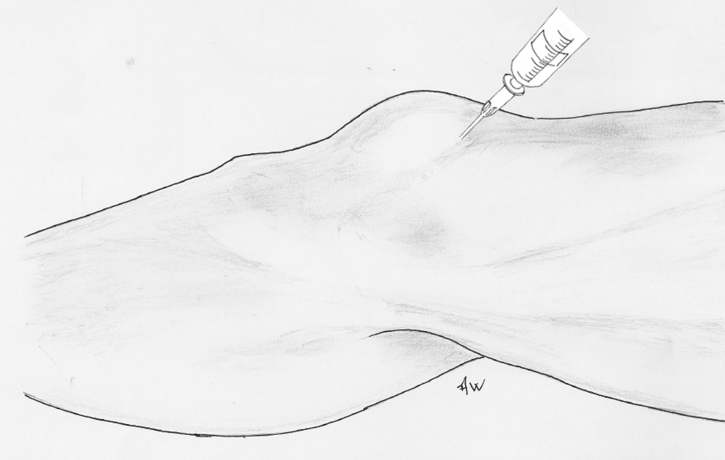 Medial approach - aspiration or injection of the knee joint ...