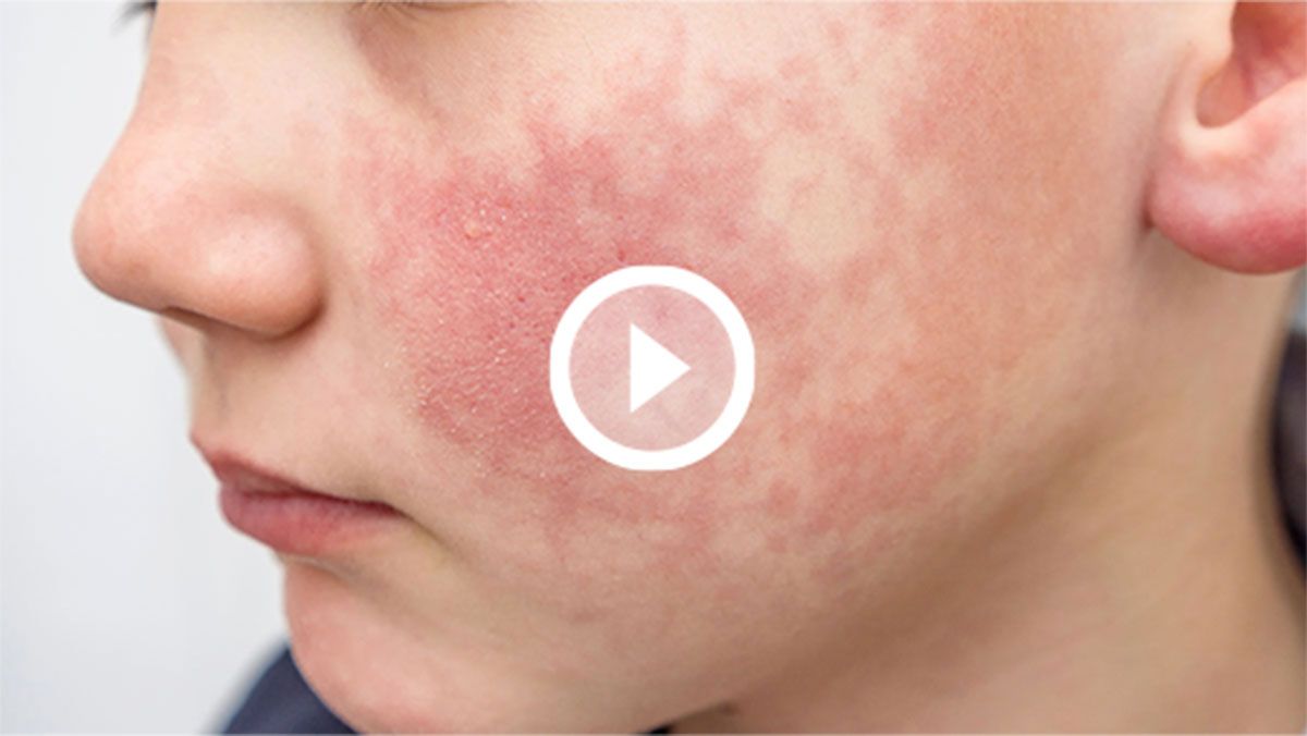 Ep 184 – Parvovirus B19 – GPnotebook