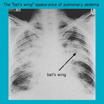 Radiograph showing bat's wing pulmonary oedema – Primary Care Notebook