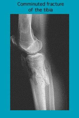 Radiograph of a comminuted fracture of the tibia – Primary Care Notebook