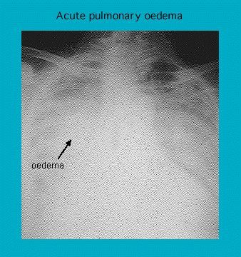 Radiografía que muestra un edema pulmonar agudo – GPnotebook