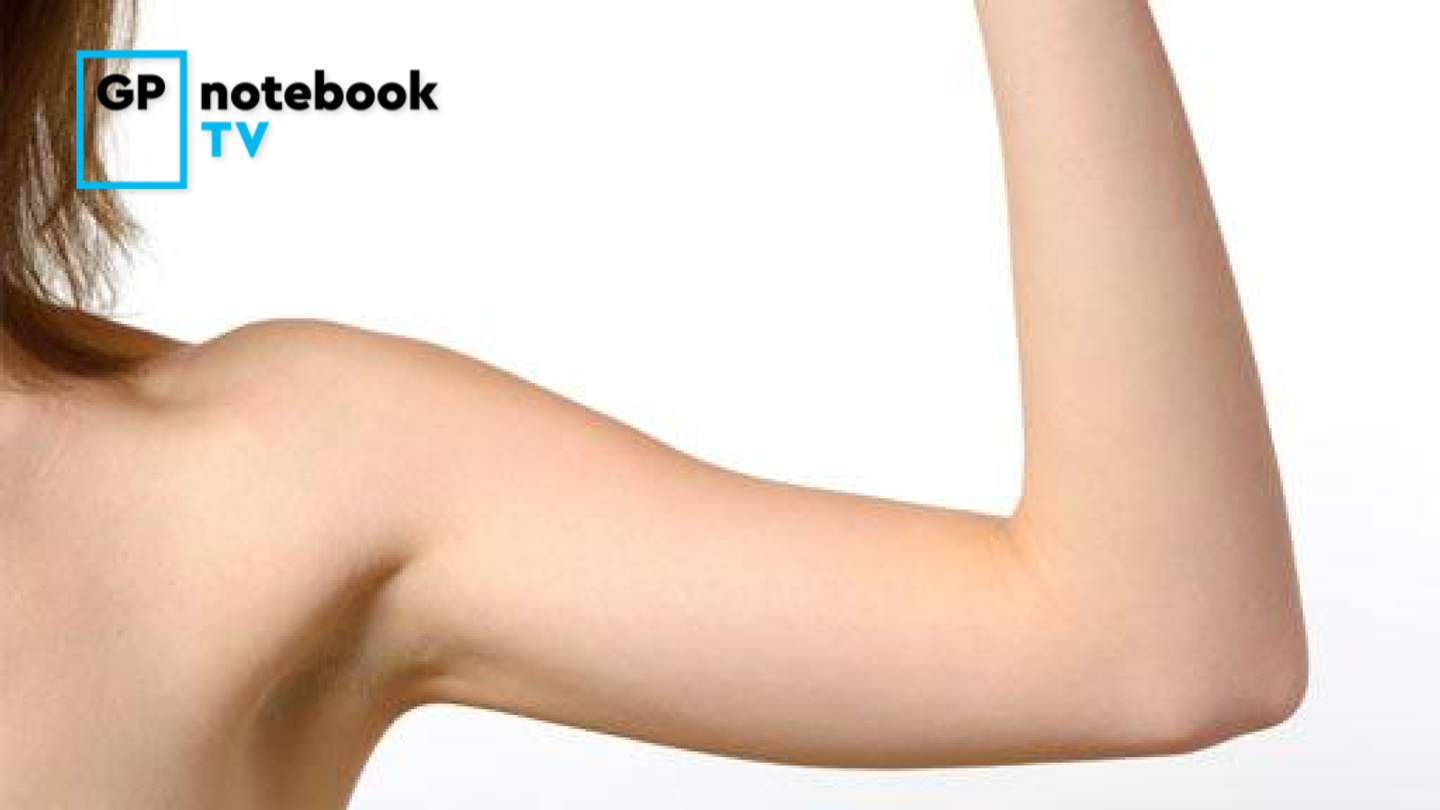 Nexplanon (etonogestrel) contraceptive implants: new insertion site