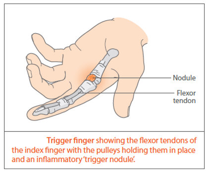 Ténosynovite sténosante (tendon fléchisseur du doigt) – GPnotebook