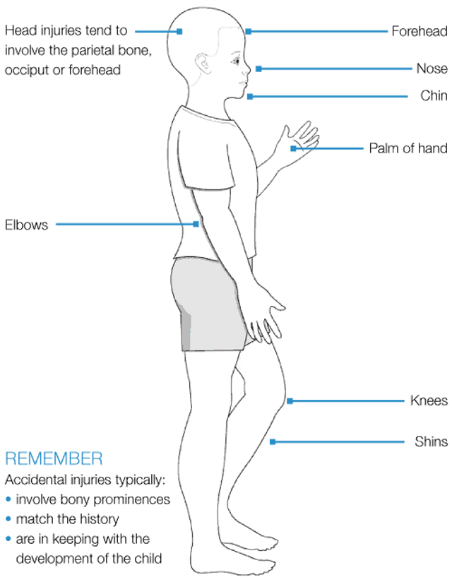 Typical features of non-accidental injuries in children (injuries that ...