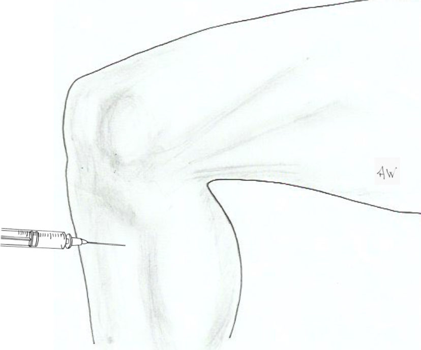 Injection or aspiration of pes anserine bursa – Primary Care Notebook