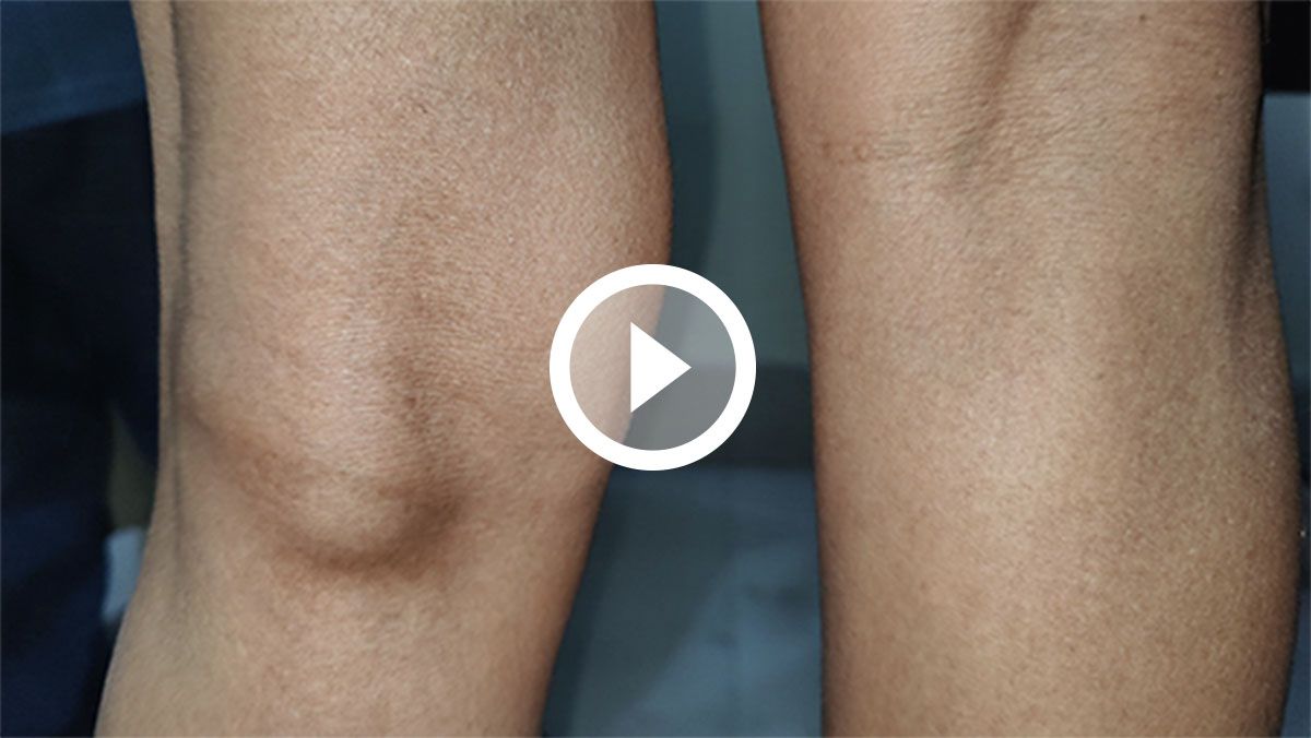 Ep 159 – Baker’s cyst – GPnotebook