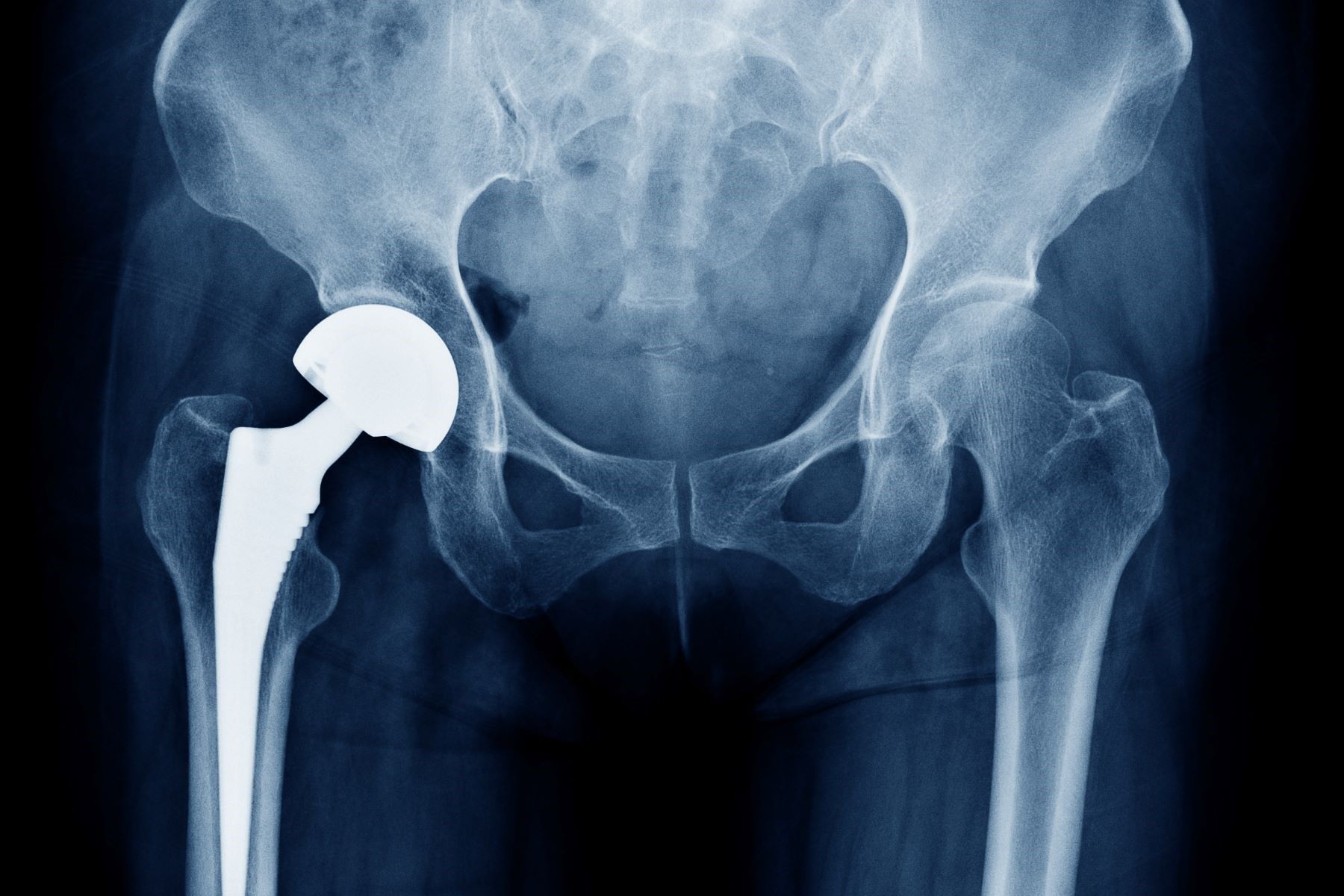 $502 Million Dollar Verdict Against Johnson & Johnson In DePuy Pinnacle ...