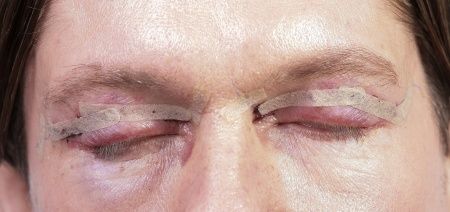 Patient Suffers Partial Vision Loss and Eyelid Retraction After ...