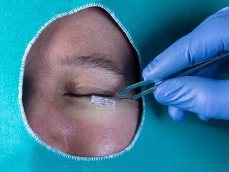 Negligent Administration of Ophthalmic Anesthesia Causes Permanent Loss ...
