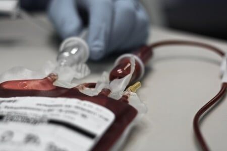 Thoracic Surgery Results in Massive Intraoperative Bleed
