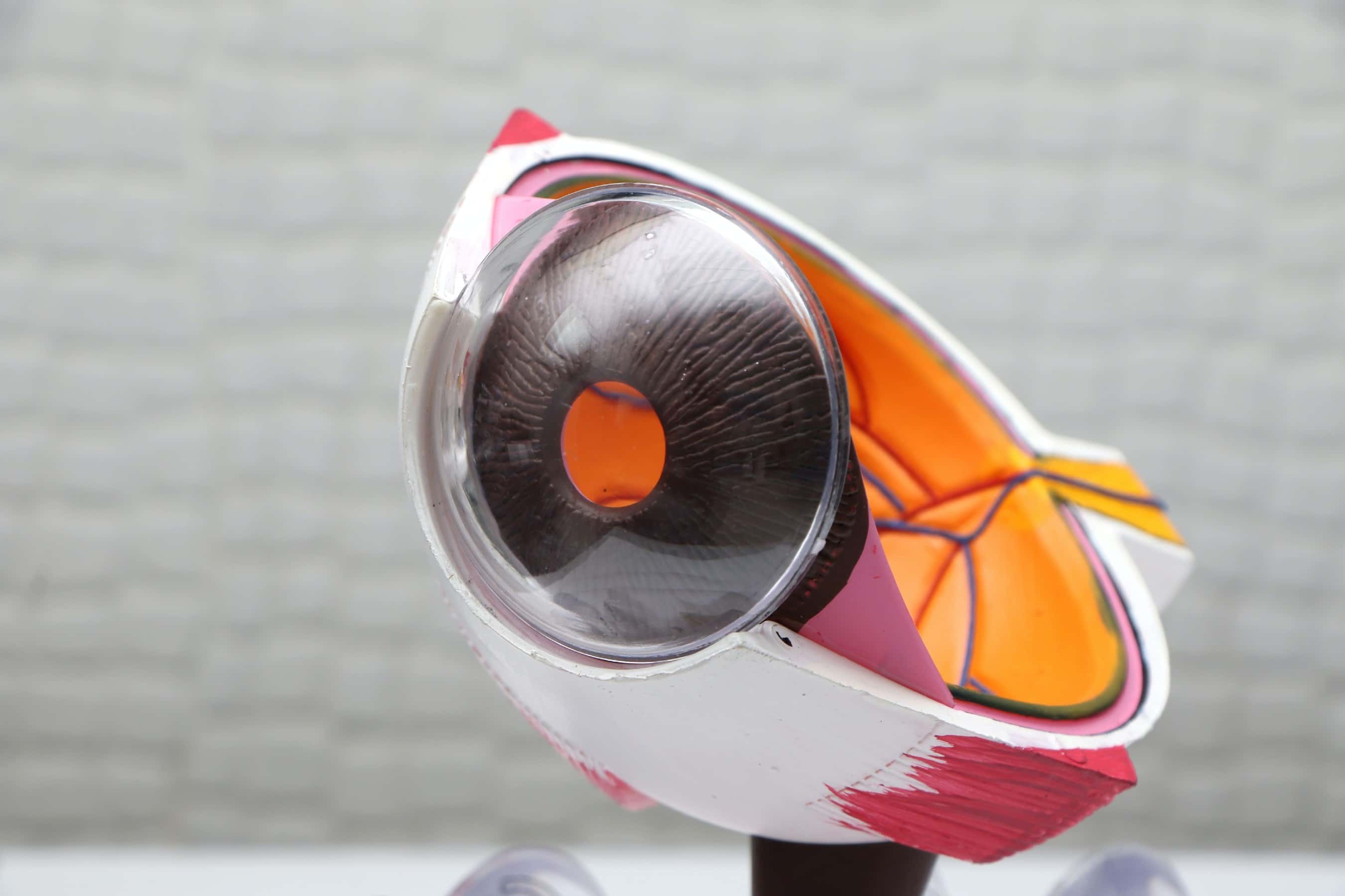 Floppy Iris Syndrome Causes and Treatment Strategies