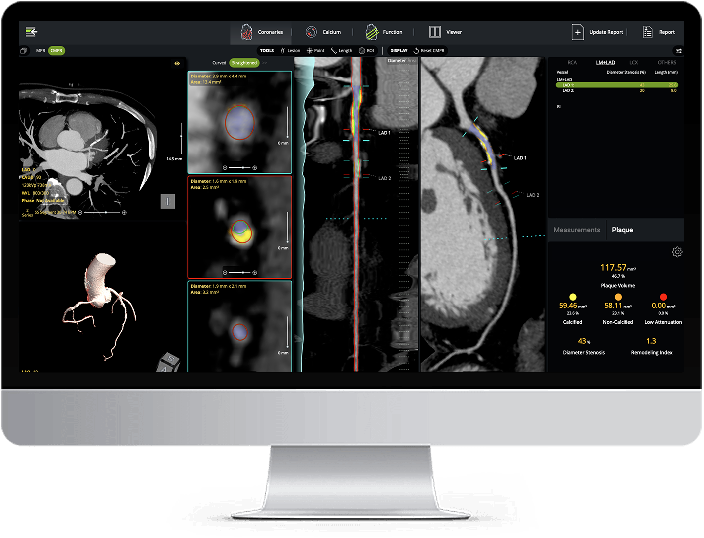 cvi42 Overview | Circle Cardiovascular Imaging