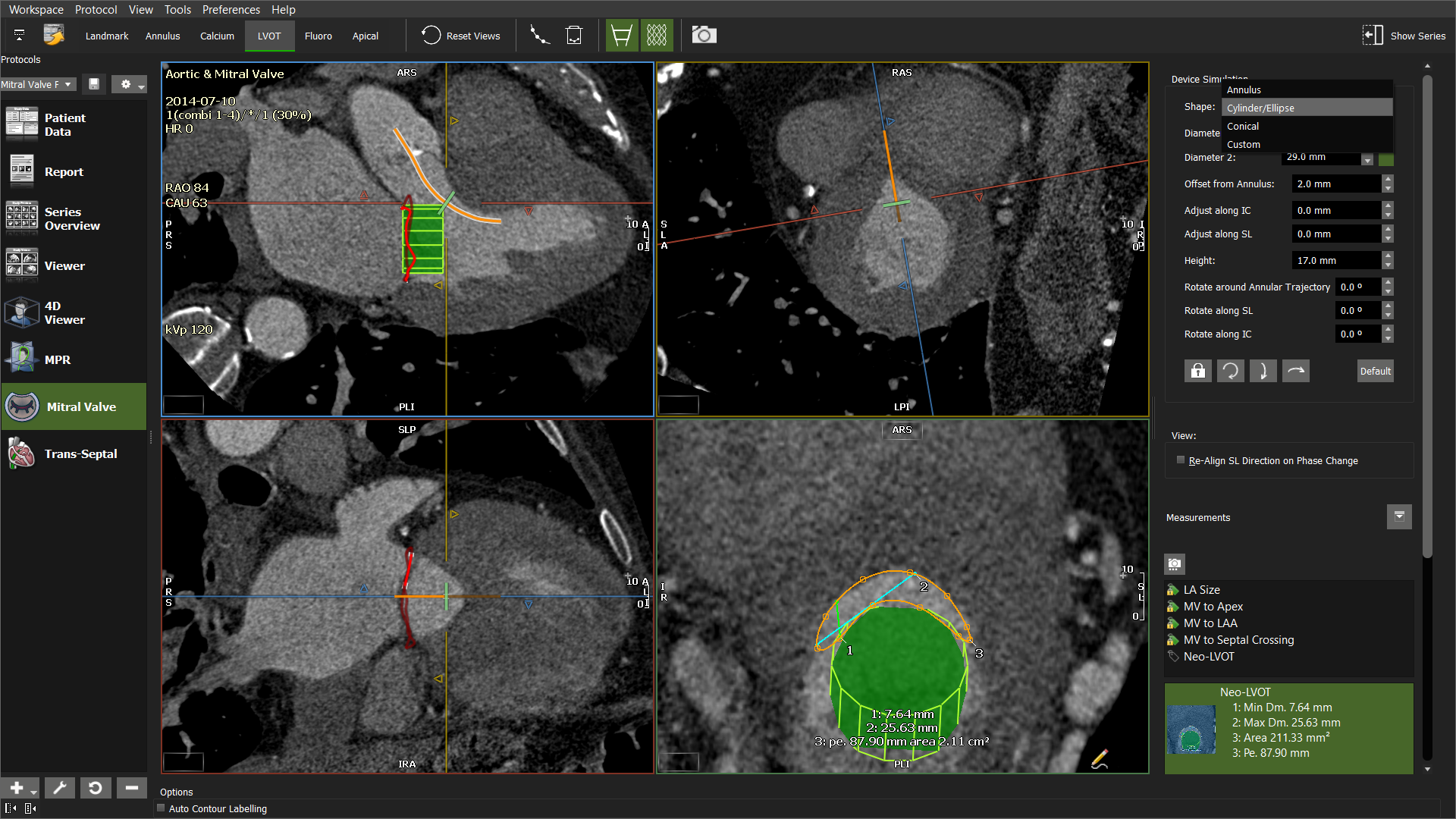 cvi42 Overview | Circle Cardiovascular Imaging