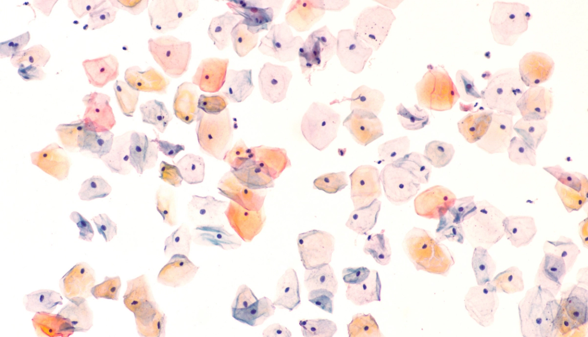My Pap Test Result was Abnormal: Now What?