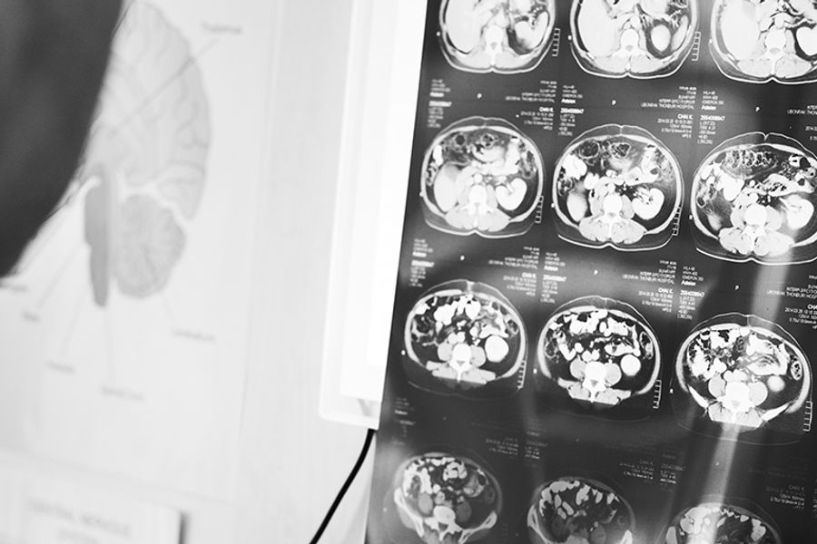 Malignant brain tumors: symptoms, diagnosis and treatment