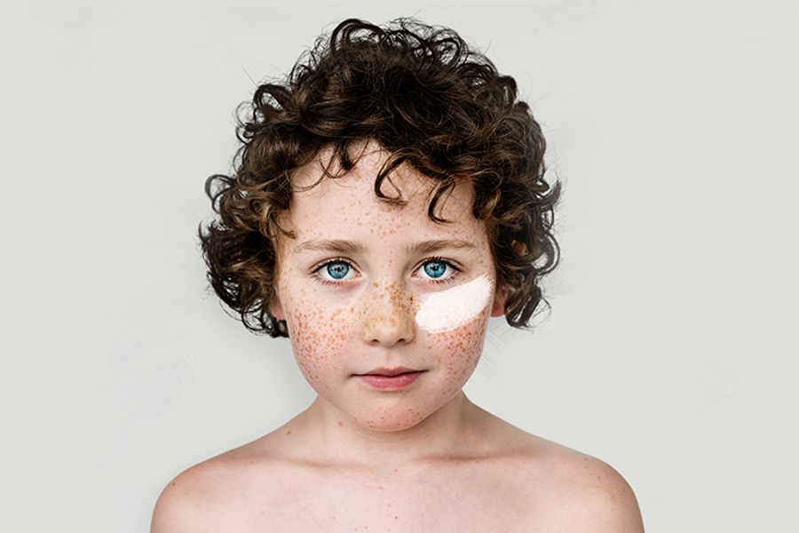 Hives (Urticaria) in children: symptoms, types and treatment