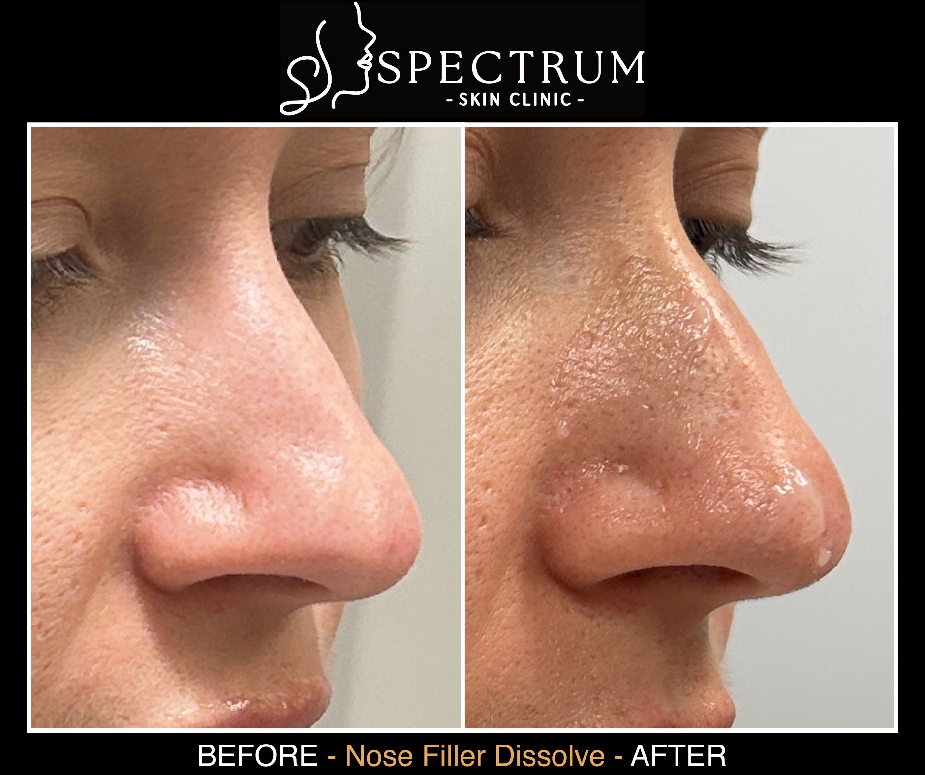 Filler Dissolve Before and After | Nasal Contour Reset Irvine CA