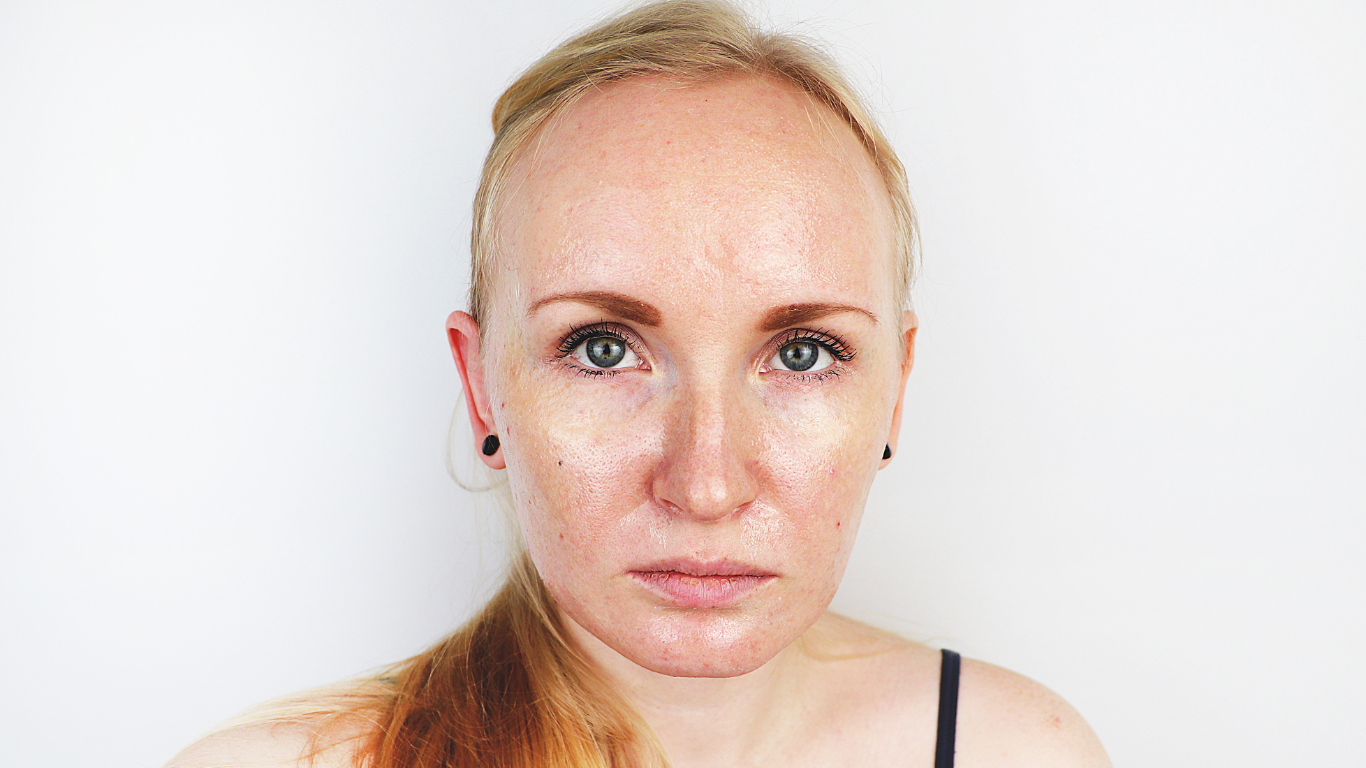 Post-Inflammatory Hyperpigmentation (PIH): Causes and Advanced ...