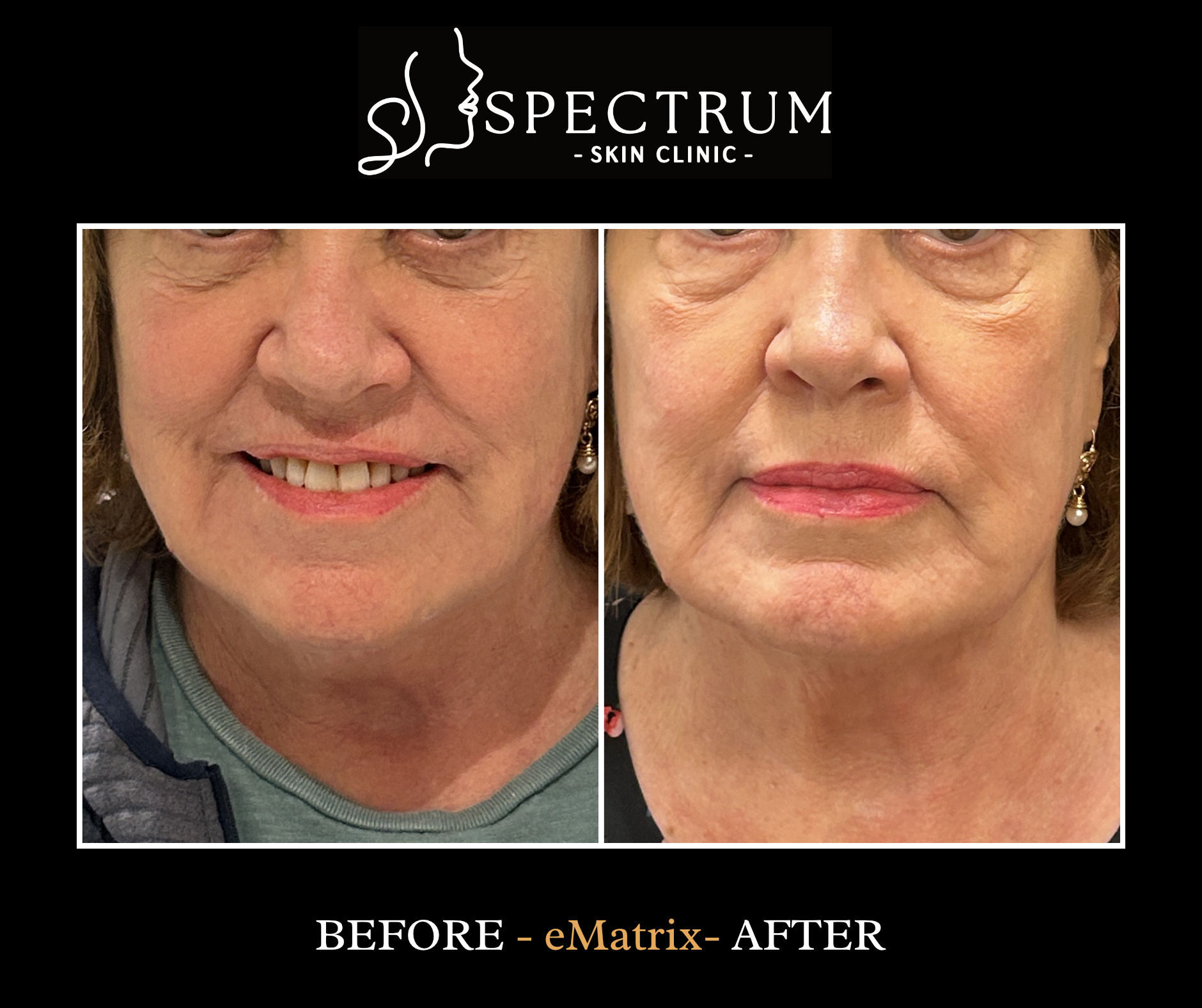 eMatrix Skin Resurfacing Before & After | Spectrum Skin Clinic, Irvine ...