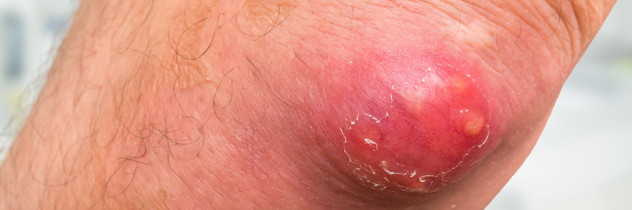 Ein Abszess - Holland-Apo.de